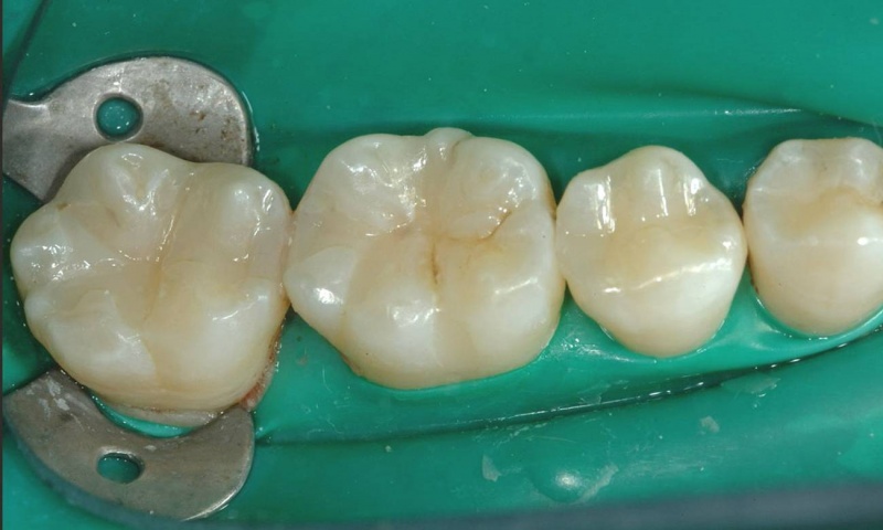 Class II Composite Resins Can Be Predictable, Non-Sensitive, and ...