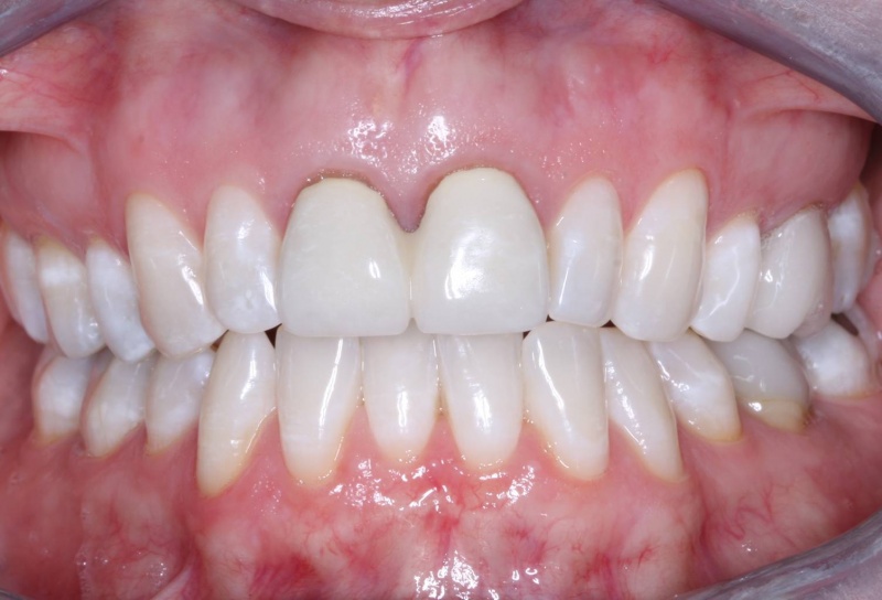 Esthetic Gingival Covering of Exposed Crown Margins, 2nd Edition ...