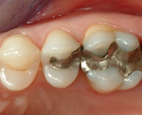 Onlays vs. Crowns - V1572 - Esthetic Dentistry - CE Video Library