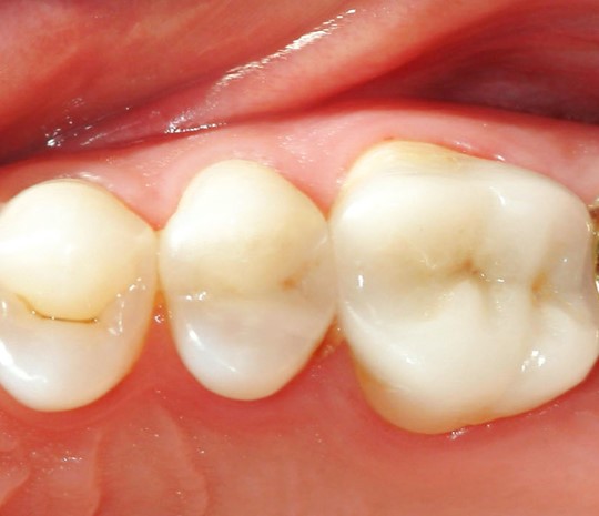 Onlays vs. Crowns - V1572 - Esthetic Dentistry - CE Video Library