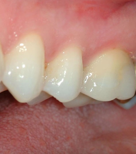 Onlays vs. Crowns - V1572 - Esthetic Dentistry - CE Video Library